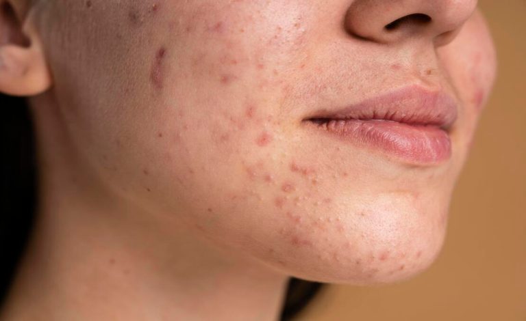Dermal Fillers for Acne Scars Before and After | FillerSupplies