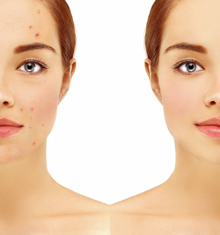 Revolax Lip Filler: Before and After the Procedure | FillerSupplies