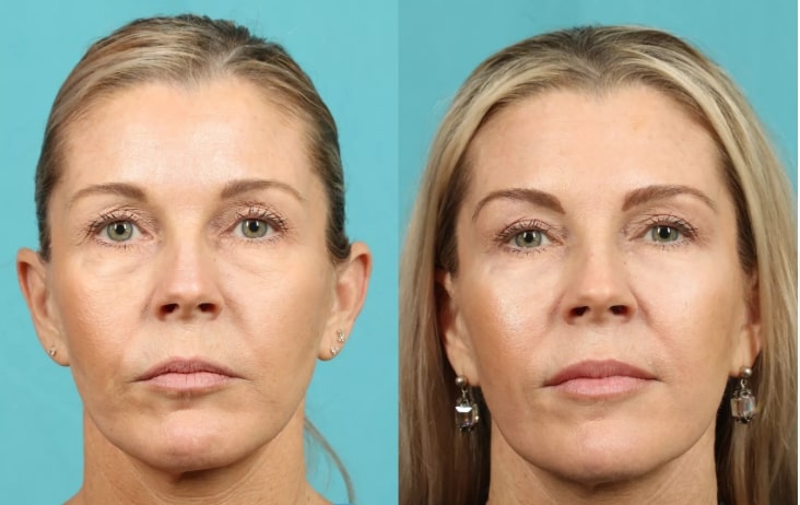 Restylane Eyelight Before and After Comparison | FillerSupplies