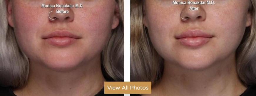 Juvederm for Vertical Lip Lines: Before and After Results | FillerSupplies