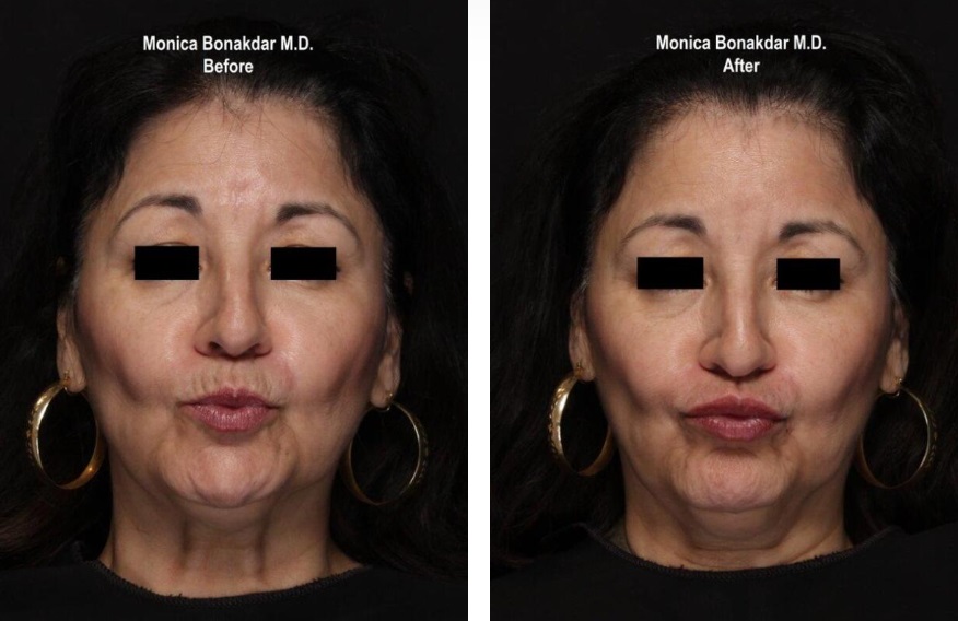Juvederm for Vertical Lip Lines: Before and After Results | FillerSupplies