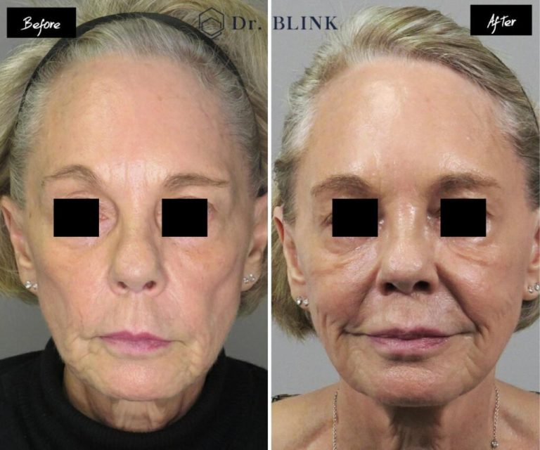 Harmonyca Allergan Before and After with Photos | FillerSupplies